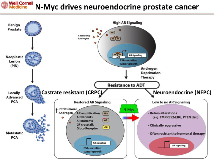 Aggressive Prostate Cancers: What’s New in Research and Treatment ...